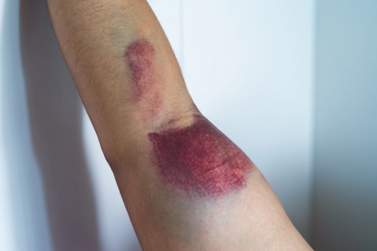 Car Accident Soft Tissue Injuries | David R. Price, Jr., P.A.